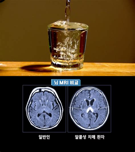 알콜성치매 의사가 설명하는 증상 보니비타민 부족으로 치매 빠져 김효진 기자 톱스타뉴스