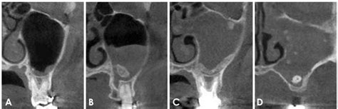 Examples Of Types Of Antroliths And The Degree Of Sinus Inflammation