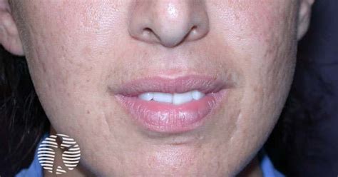 Atrophic Acne Scars Image