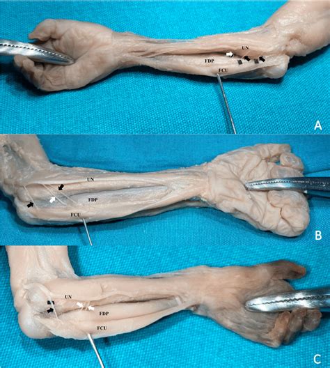 Type Ii Pattern And View Of Its Subtypes A Type Iia Case 22 Right Download Scientific