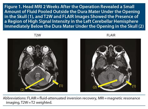 Auditory Hallucinations After Microvascular Decompression For