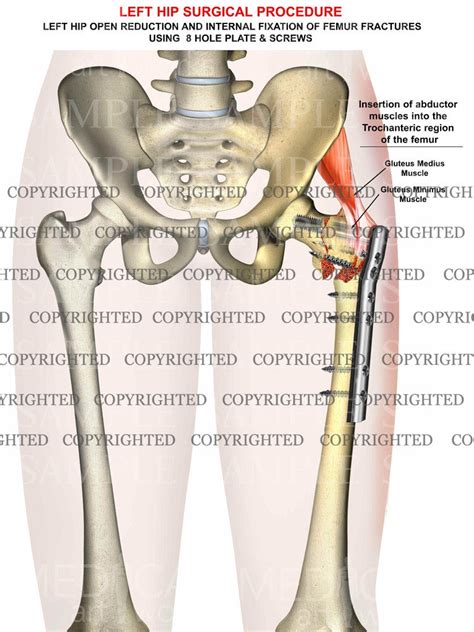 Open Reduction Internal Fixation Hip