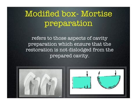 Amalgam Cavity Preparation Class I Pdf