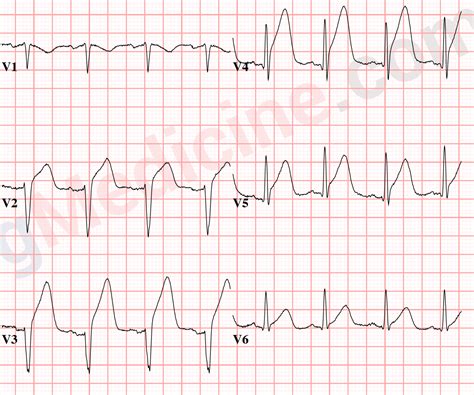 Teaching Medicine Tutorial Acs Plus