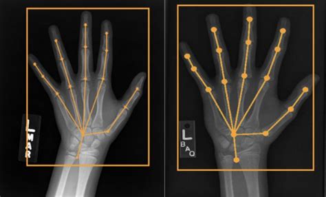Hand Pose Estimation For Pediatric Bone Age Assessment Biomedical