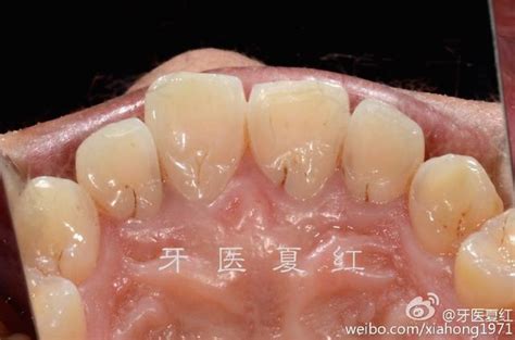 你不知道的前牙窩溝封閉術 每日頭條