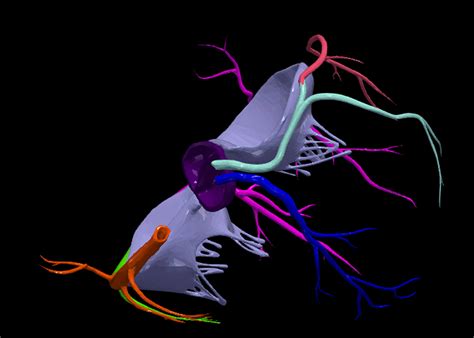 3d Model Of Bicuspid Aortic Valve Bav By Azekapeka