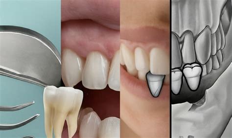 Do They Break Your Jaw To Remove Wisdom Teeth
