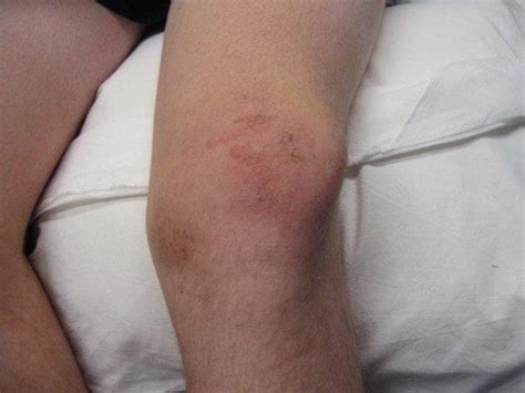 Patellar Dislocation • Litfl • Trauma Library