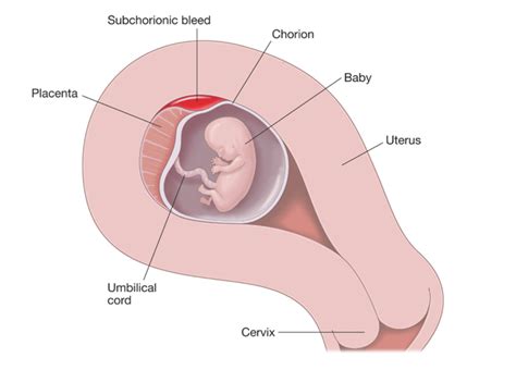 Subchorionic Hemorrhage New Direction Fertility Centers