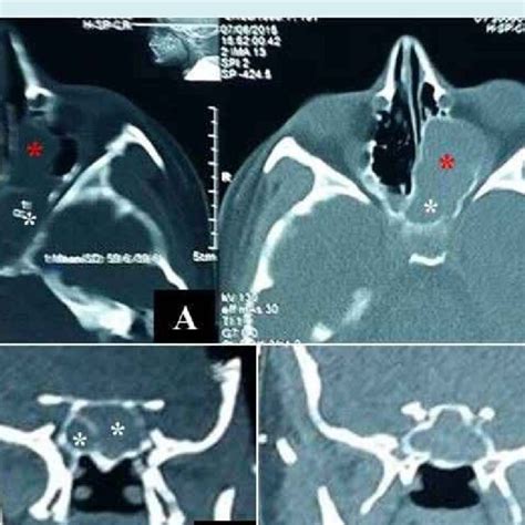 Ct Scan With Axial Bone Window Cut A And Axial Soft Tissue Cut B