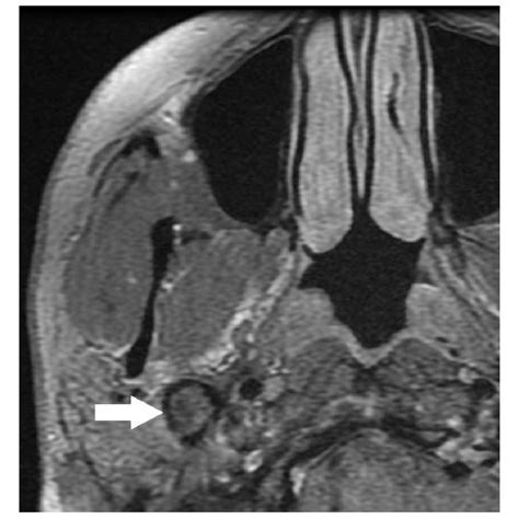 A Mri Shows That The Material In The Pneumatised Right Styloid