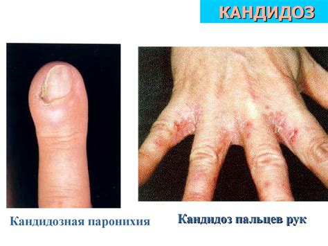 Грибковые заболевания кожи презентация онлайн