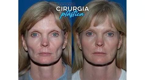 Lipoenxertia Valor O Que é Antes E Depois Com Fotos Em 2025 Tudo
