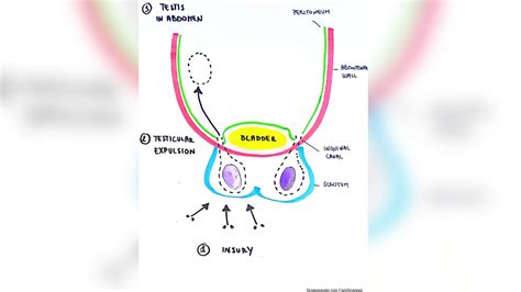 Motorcycle Crash Dislocated A Mans Testicle Into His Abdomen Live S