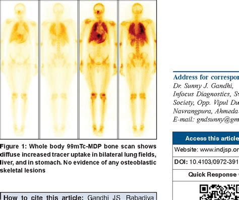 Figure 1 From Extensive Visceral Calcification Demonstrated On 99mtc Mdp Bone Scan In Patient