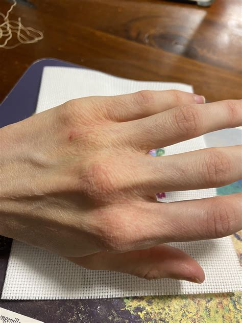 Product Request Dermatitis Dry Skin On Knuckles Rskincareaddiction