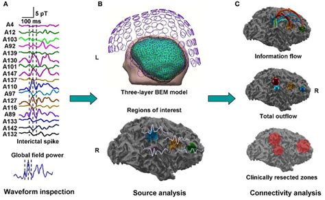Estimated Direction Of Propagation Of Epileptiform Activity Along