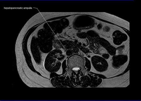 Anatomy Biliary System Free Mri Axial Cross Sectional Anatomy Of The