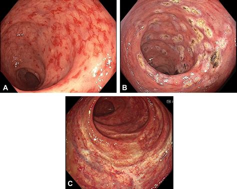 Risk Factors Of Bleeding Ulceration After Argon Plasma Coagulation In