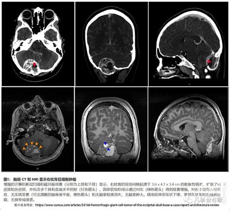 【推荐】颅骨肿瘤之良性肿瘤 脑医汇