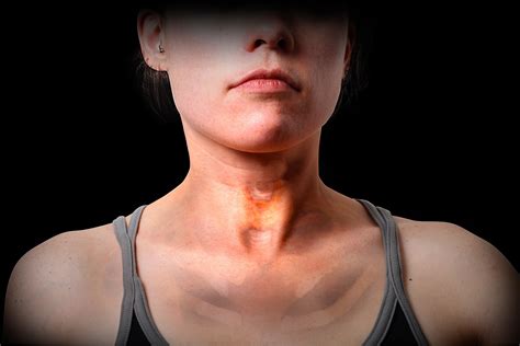 Thyroid Nodules