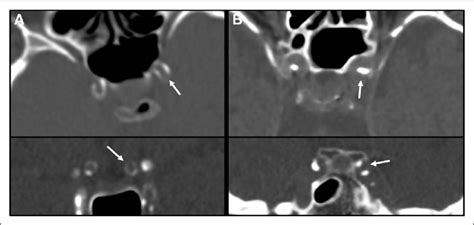 Patterns Of Medial And Intimal Intracranial Carotid Artery Download Scientific Diagram