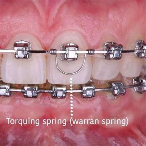 Jual Dental Torque Spring Universal Labial Lingual Root Torquing Ortho Shopee Indonesia