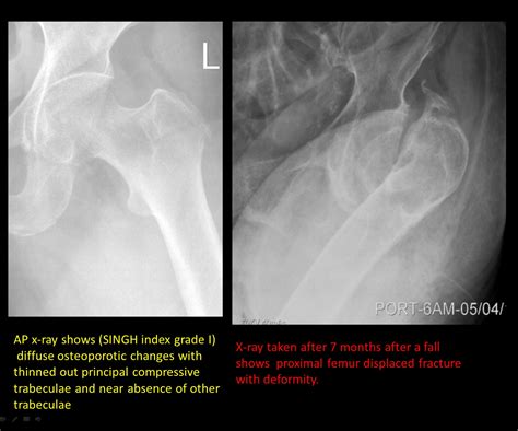 Osteoporosis X Ray Vs Normal
