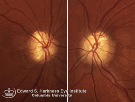 Optic Nerve Drusen Vagelos College Of Physicians And Surgeons