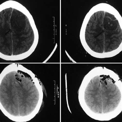 Initial Computed Tomography Scan Demonstrating Pre And Post Operative