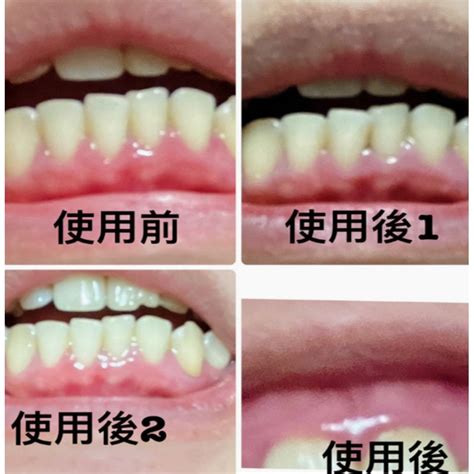 十全牙粉 遺山牢牙散 潔牙粉美白牙粉 牙齦護理發炎紅腫萎縮出血敏感口臭洗牙粉 非固齒神方牙周適3q黃人牙粉結石菸垢檳榔垢 蝦皮購物