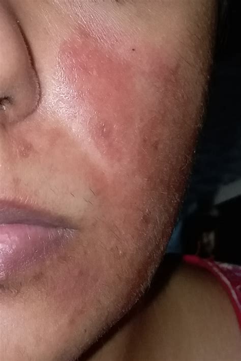 Bleach Chemical Burn