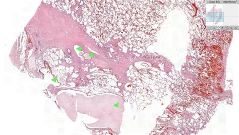 Histology Image Of The Resected Pulmonary Section Dilated Bronchial Download Scientific