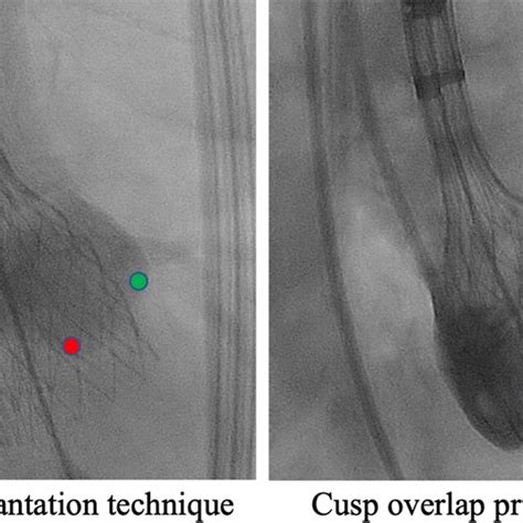Classical Three Cusp Coplanar Projection Is Shown On The Left Side Download Scientific Diagram