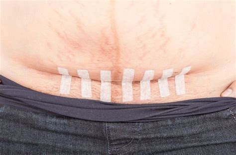 What Should I Do About My C Section Scar — Alma Physiotherapy