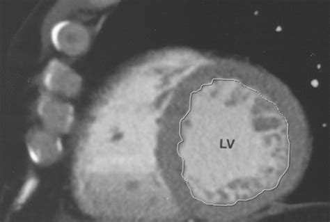 Using Ecg Gated Multidetector Ct To Evaluate Global Left Ventricular Myocardial Function In