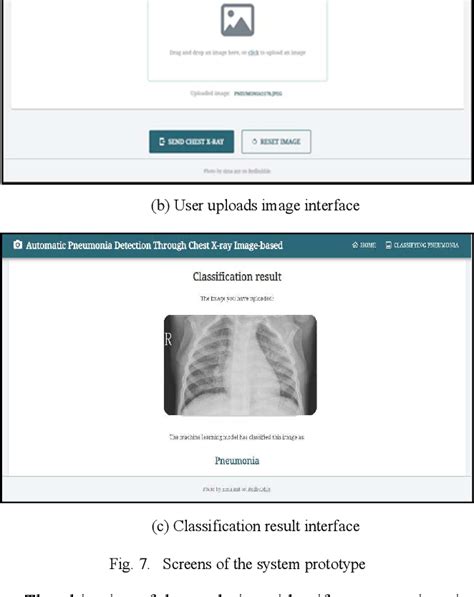 Figure 7 From Automatic Pneumonia Detection Through Chest X Ray Image Based Semantic Scholar