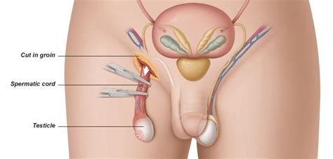 46xy Differences Of Sexual Development Endotext Ncbi 43 Off