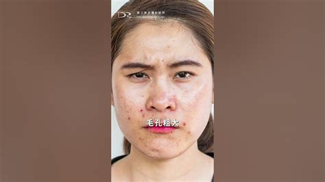 臉上蠕形蟎蟲的7大警訊，你中招了嗎？ 蠕形蟎蟲 痘痘 青春痘 皮膚粗糙 脫皮 膚色暗沉 敏感肌 毛孔粗大 Youtube