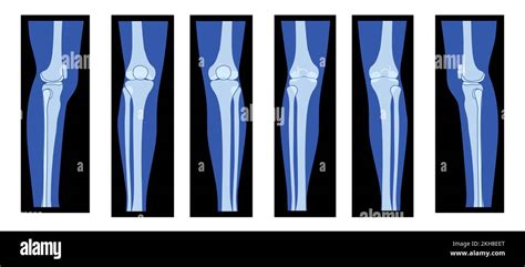 Set Of X Ray Knee Femur Leg Skeleton Human Body Patella Epicondyle Tibia Fibula Bones Adult