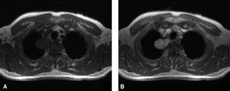 Magnetic Resonance Imaging Mri Revealed A Tumor Of Homogeneous Signal