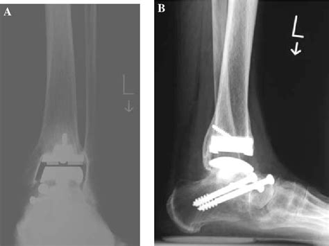 Figure 2 From Turndown Retinacular Flap For Closure Of Skin Fistula