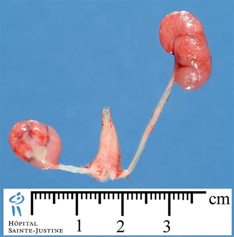 Renal Ectopia Human Pathology