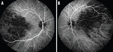 Choroidal Metastasis Associated With Oropharyngeal Carcinoma Retina Today