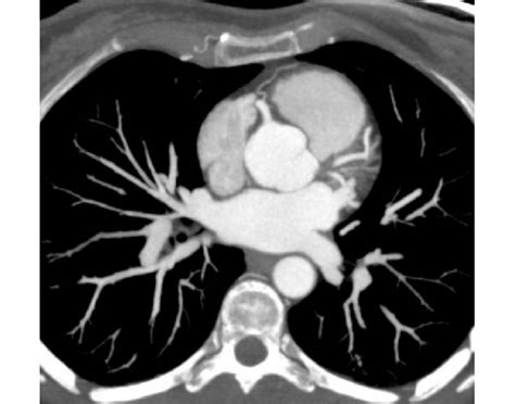Axial Chest Ct Heart Quiz