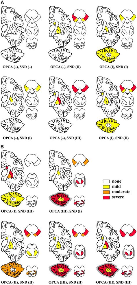 The Msa Neuropathological Scoring System Reproduced From Jellinger K