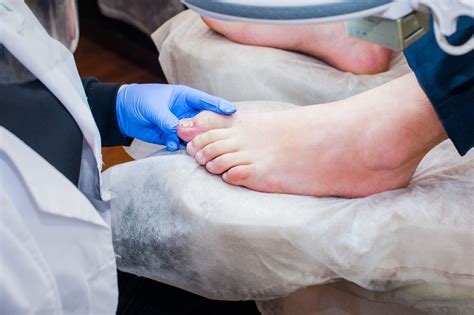 Ingrown Toenail Baton Rouge Baton Rouge Ingrown Toenail Doctor
