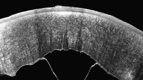 Pentacam® Cornea Oct Oculus Int