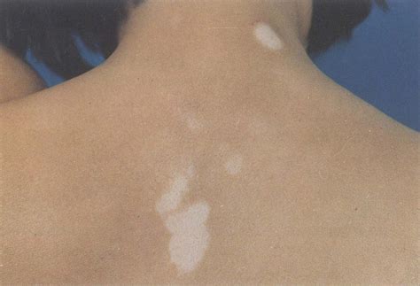 一、白癜风 临床皮肤病及性病彩色图谱